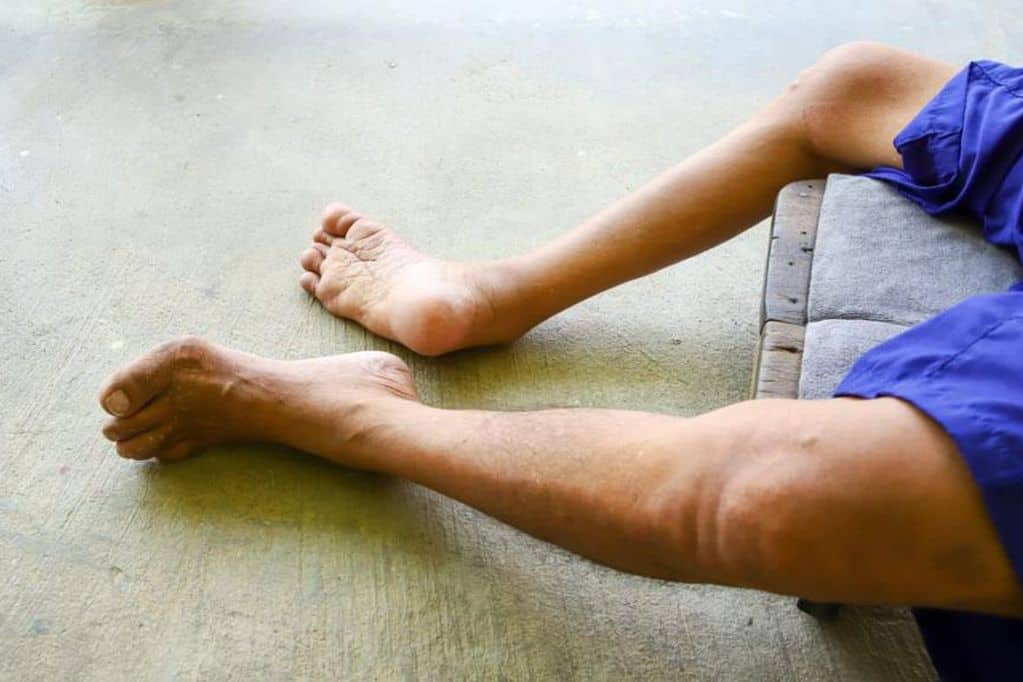 Los riesgos de la polimielitis en la Argentina - ACMS | Academia de ...